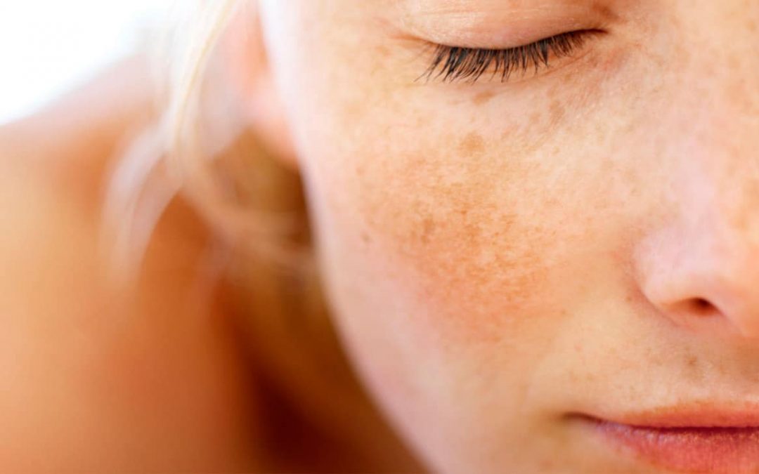 Macchie Viso – CLINICA PULVIRENTI – FACE ANTIAGING SPECIALIST